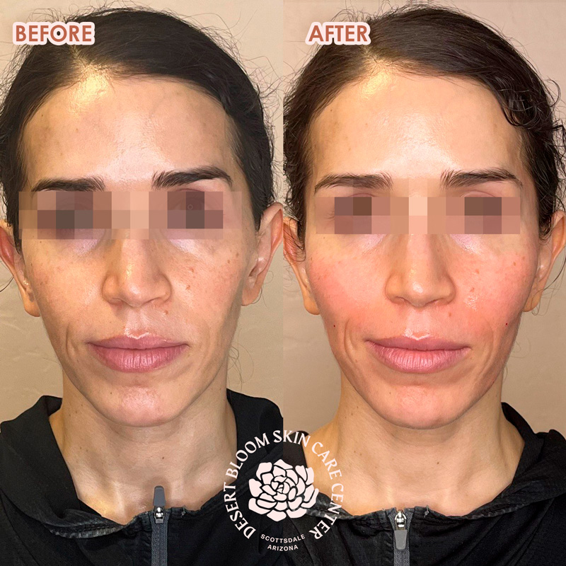 Facial fat for women over 40.