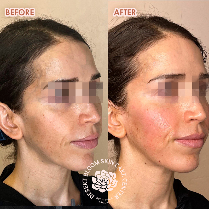 Facial fat for women over 40.