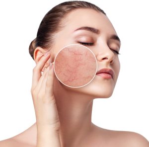 Enhance Your Appearance with PDO Thread Lift: Achieve Captivating 'Fox ...