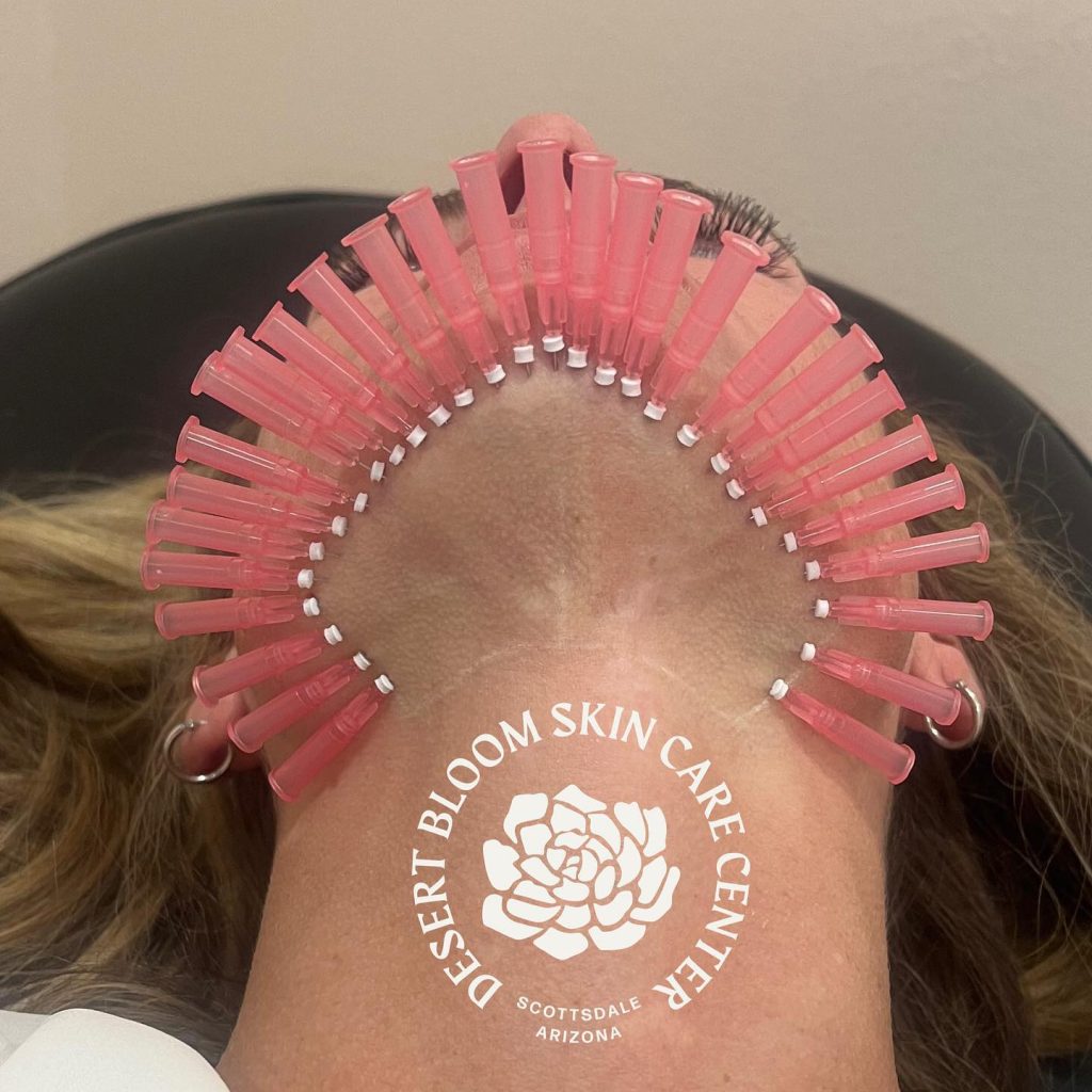 Neck Thread Lift in Scottsdale, AZ | PDO Thread Lift for Neck