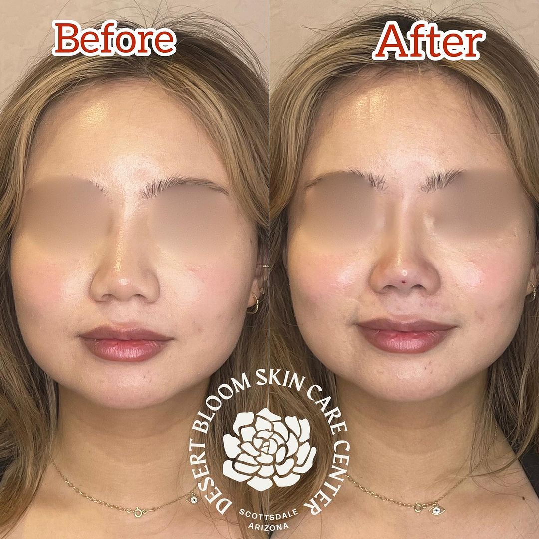 Non surgical nose job with PDO threads in Phoenix, AZ