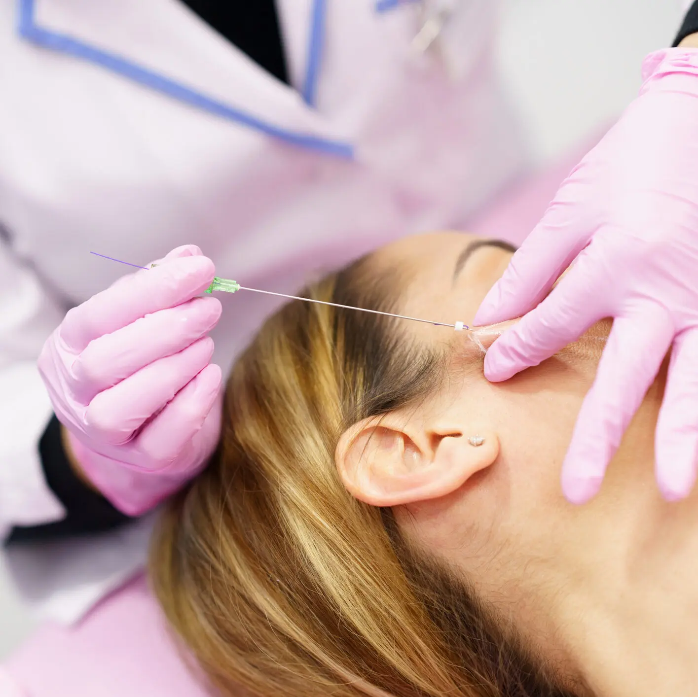 PDO Facial Thread Lift near me | Scottsdale, Phoenix AZ