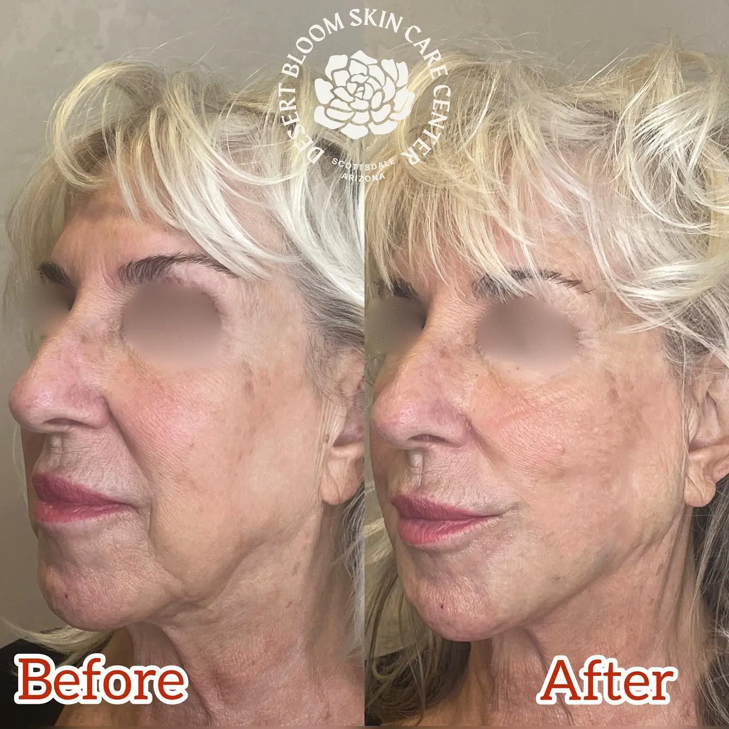 PDO Thread Lift | Lifting Threads in Scottsdale, AZ