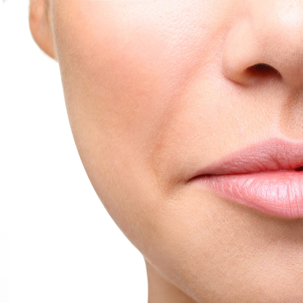 Nasolabial Fold Treatment Scottsdale AZ | Desert Bloom