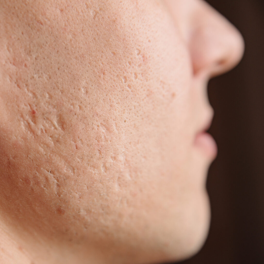 Acne scars Treatment | Desert Bloom Skin Care Center