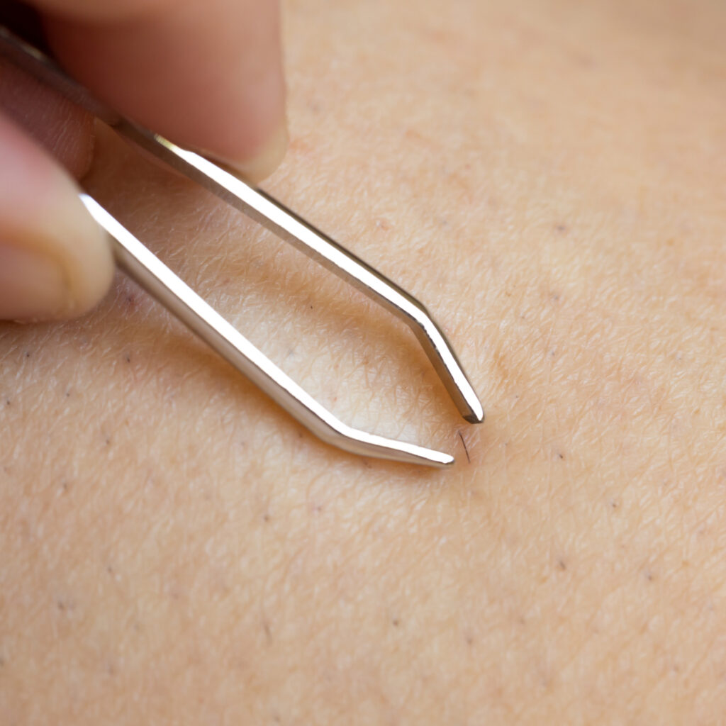 Ingrown Hairs Treatment | Desert Bloom Skin Care